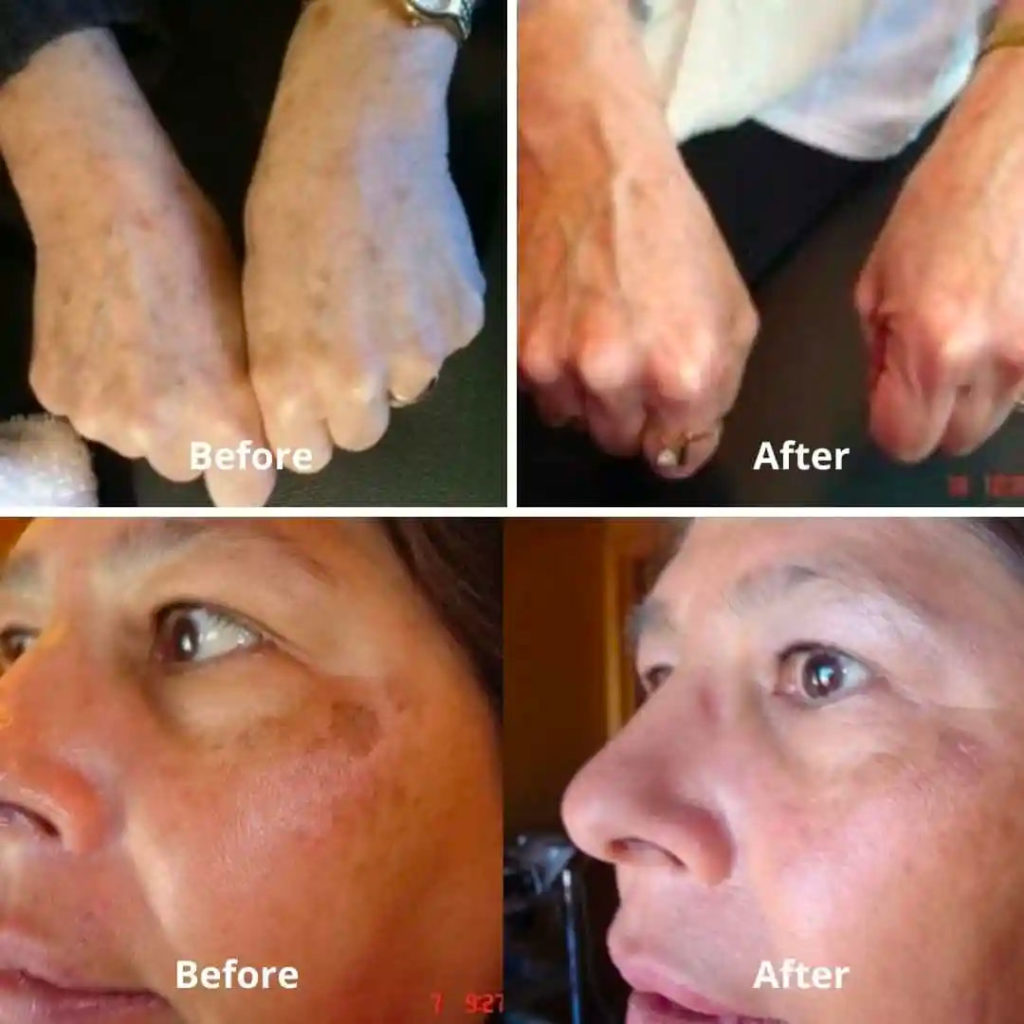 Skin Classic Skin Rejuvenation in Indianapolis, IN | Skin Renew