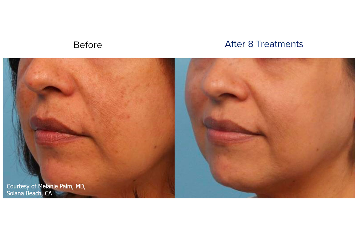 Hollywood Peel In Indianapolis In Skin Renew Day Spa And Laser Center
