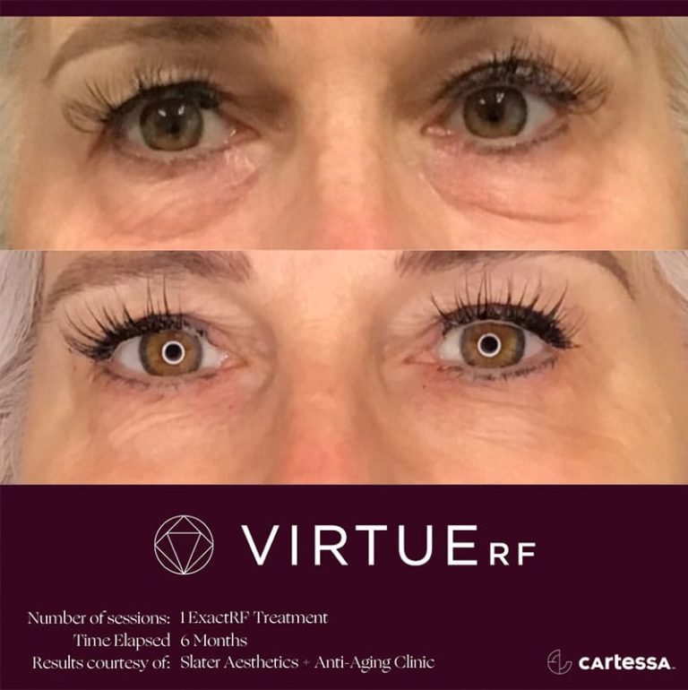 Virtue RF Indianapolis, IN | Skin Renew Day Spa & Laser Center