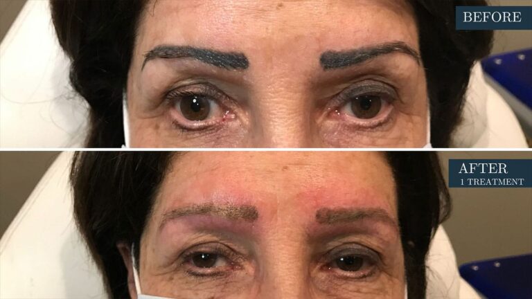 Eyebrow Tattoo Removal in Indianapolis, IN | Skin Renew