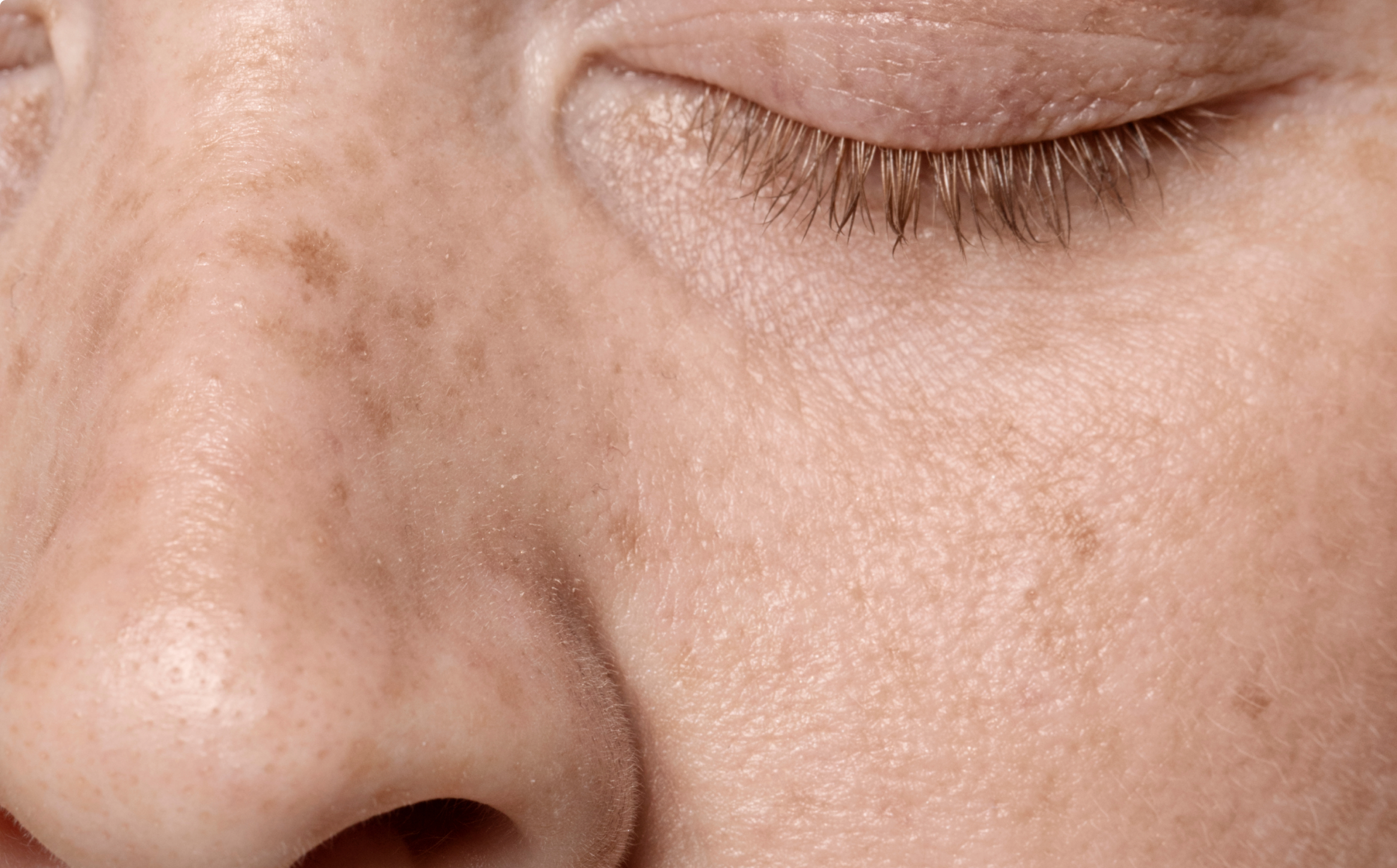 Age Spot Removal - Skin Renew Day Spa & Laser Center